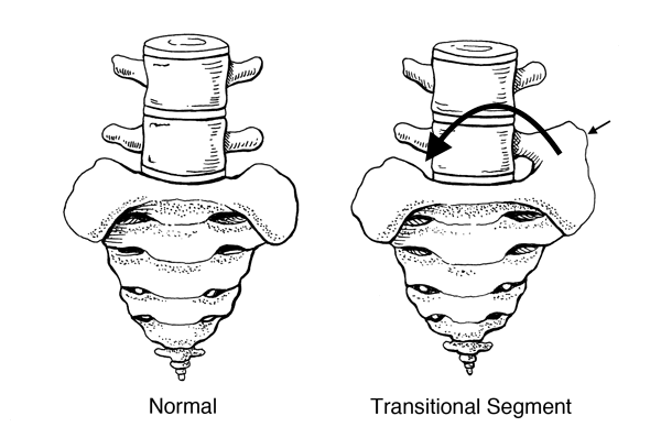 Sacralization : Cause, Symptoms, Diagnosis, Treatment, Exercise