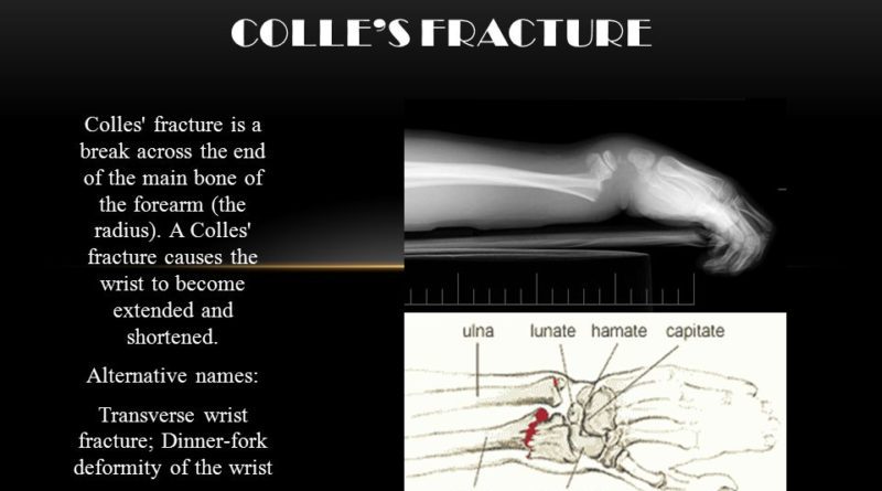 Colle's fracture: - SAMARPAN PHYSIOTHERAPY CLINIC AHMEDABAD