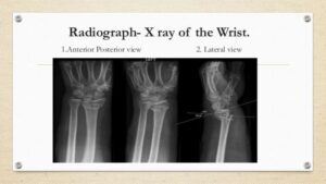 Colle's Fracture - Causes, Symptoms, Treatment - Samarpan
