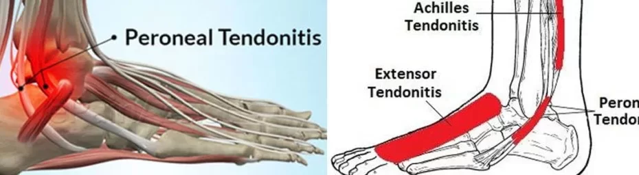 Peroneal Tendinitis Cause, Symptom, Diagnosis, Treatment
