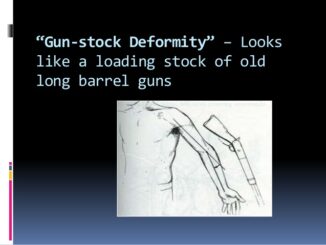 Gunstock Deformity - Cause, Symptoms, Treatment