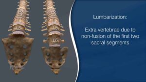 Lumbarization ; Cause, Symptom's, Diagnosis, Treatment, Exercise