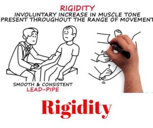 What are Spasticity and Rigidity? Spasticity - Rigidity Comparison ...