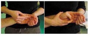 What is Dactylitis- Sausage finger? – Samarpan Physiotherapy Clinic