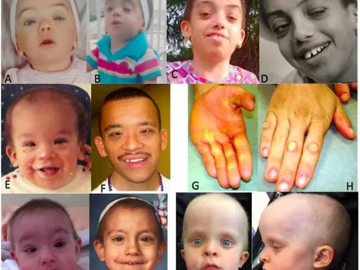 Sindrome Di Costello Musculo Skeletal Phenotype Of Costello Syndrome