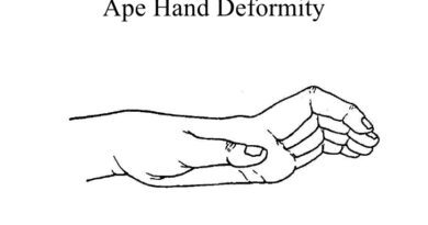 Wartenberg’s syndrome (superficial radial nerve neuritis)