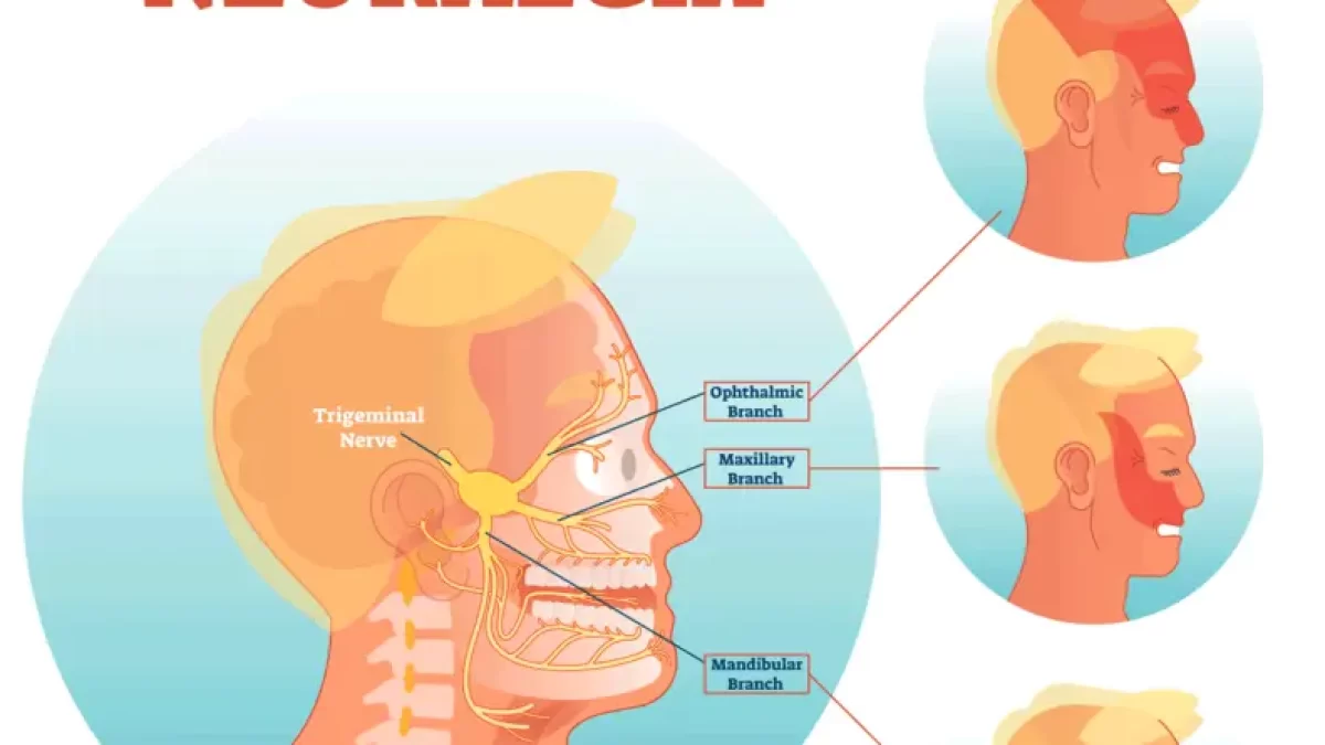 Trigeminal Neuralgia Trigger Points 6595
