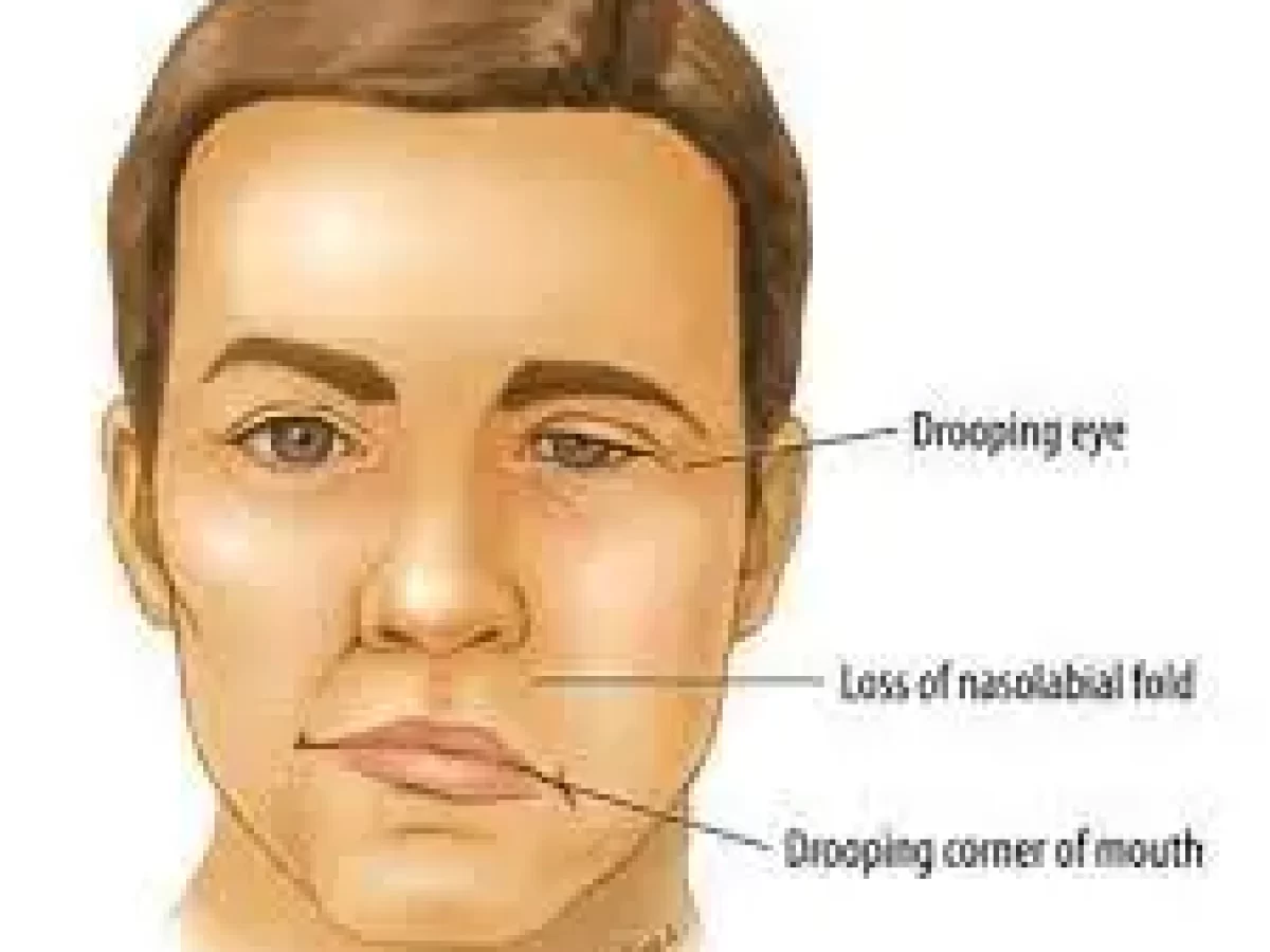 Bilateral Facial Nerve Palsy