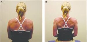 Scapular Dyskinesia - Cause, Symptoms, Treatment, Exercise