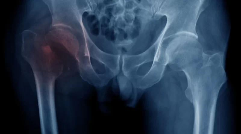 avulsion fracture treatment Archives - SAMARPAN PHYSIOTHERAPY CLINIC ...