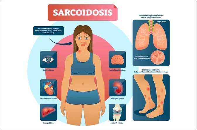 Sarcoidosis Types, Cause, Symptoms, Diagnosis, Treatment