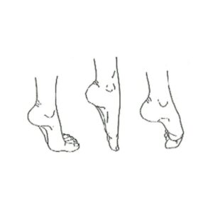 Deformity Of Toes - Cause, Symptoms, Treatment, Exercise