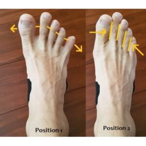 Deformity Of Toes - Cause, Symptoms, Treatment, Exercise
