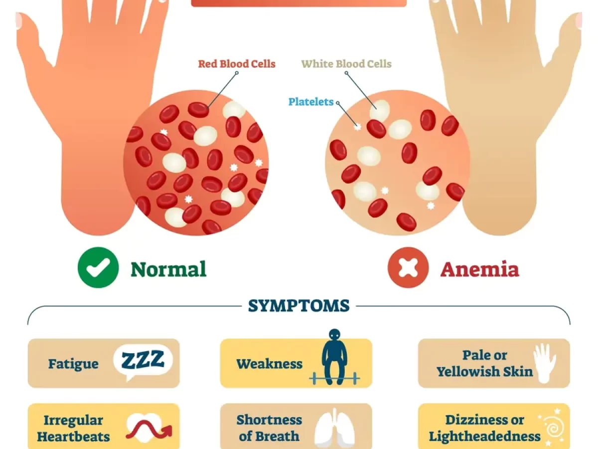 Sintomas De Anemia Anemia Por Deficiencia De Hierro YouTube