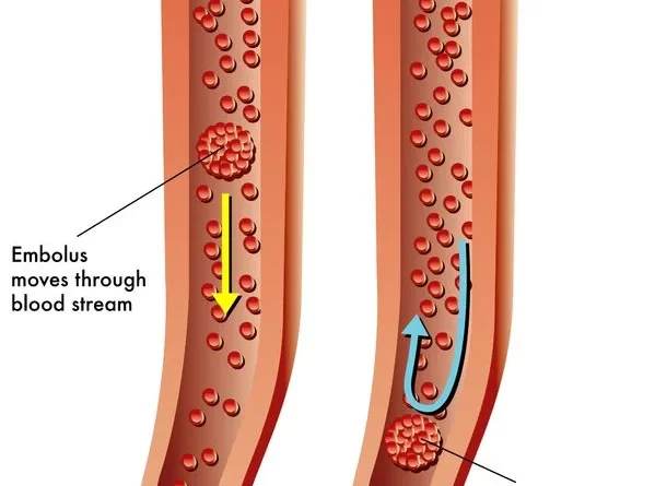 cardiac embolism death Archives - SAMARPAN PHYSIOTHERAPY CLINIC AHMEDABAD