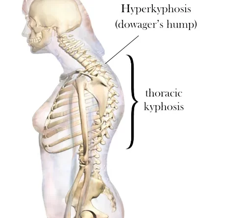 why is it called dowager's hump Archives - SAMARPAN PHYSIOTHERAPY ...