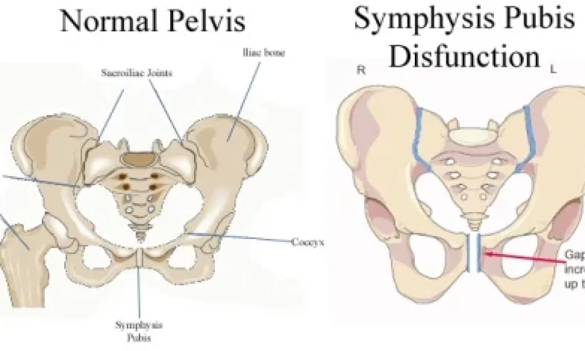Symphysis Pubis Dysfunction Causes Symptoms Treatment 57 OFF