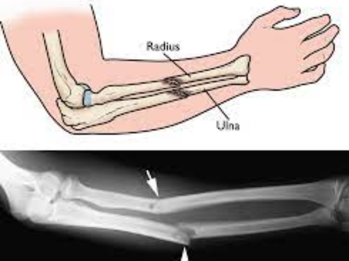 Nightstick Fracture