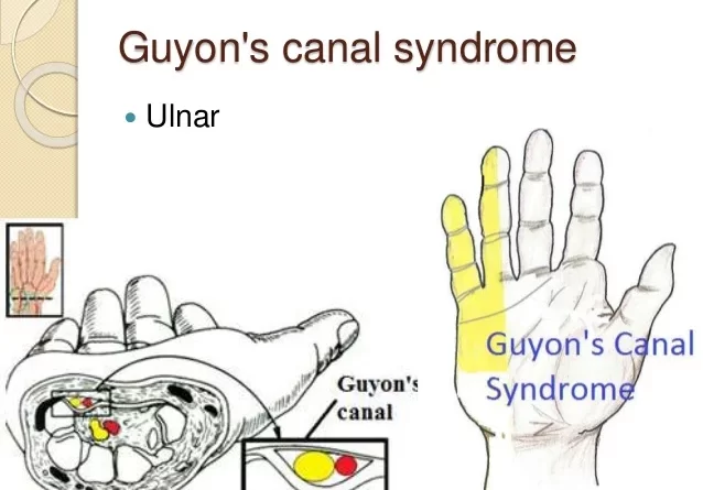 guyon's canal syndrome exercises Archives - SAMARPAN PHYSIOTHERAPY ...