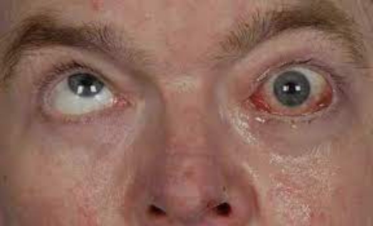 Identifying Ptosis Of The Eye Ppt - Infoupdate.org