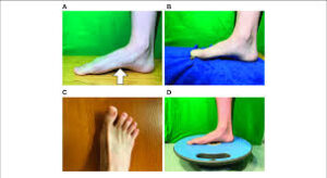 Plantar Plate Tear - Mechanism of Injury, Symptoms, Treatment